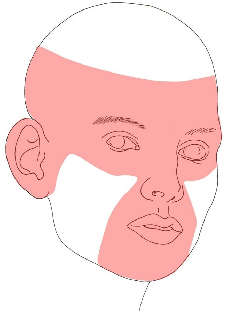 Mohs Micrographic Surgery | Mohs Specialist | Houston | The Woodlands ...