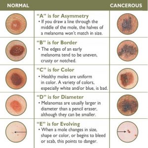 Types of Skin Cancers | Dermatologist Woodlands | Houston | Katy Texas
