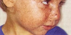 Xeroderma Pigmentosum (XP) Symptoms, Treatment | Houston, Spring Texas