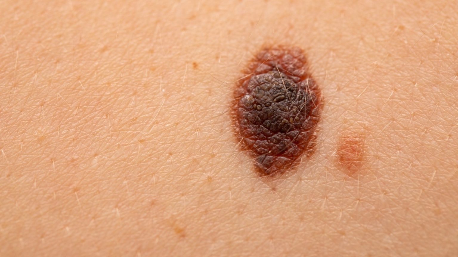 Malignant Melanoma (MM) Skin Cancer Treatment Houston TX | Spring ...